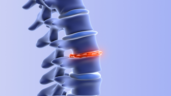 Understanding Disc Bulge: Causes, Symptoms, and Treatment Options ...